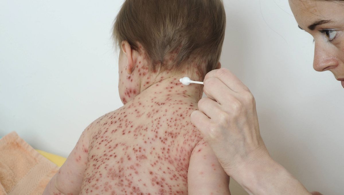 Comment reconnaître la varicelle? - Vous et Votre Santé